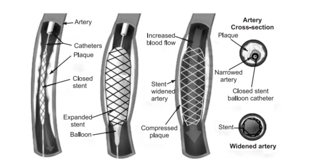 Diagnosis And Treatment Of Atherosclerosis - Pharmacy Medicine Drugs