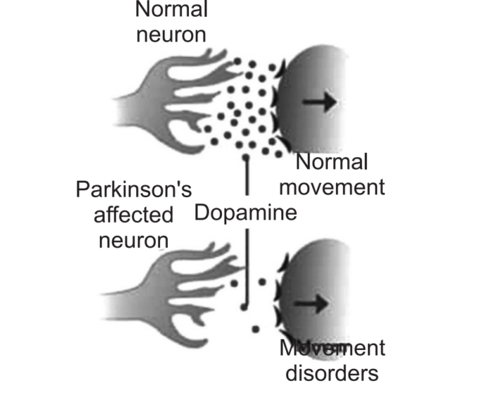 Parkinson disease (PD) ⚕️ | What Is It ? | How Its Caused🔍 - Pharmacy ...